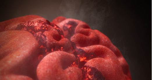 Acute & Smoldering Neuroinflammation